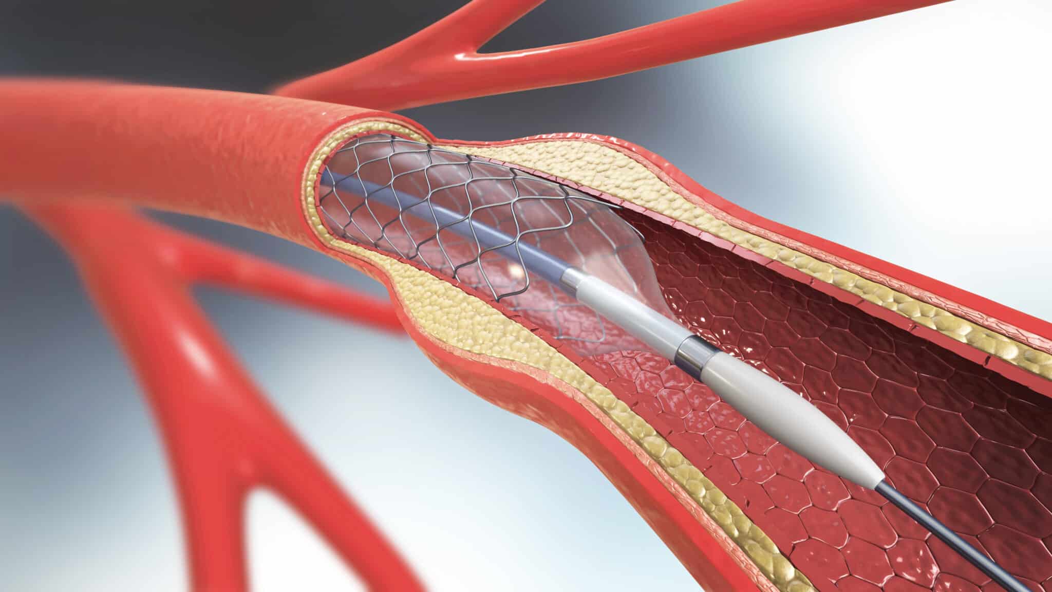 PICC-Line et Mid-line : quelles différences en pratique